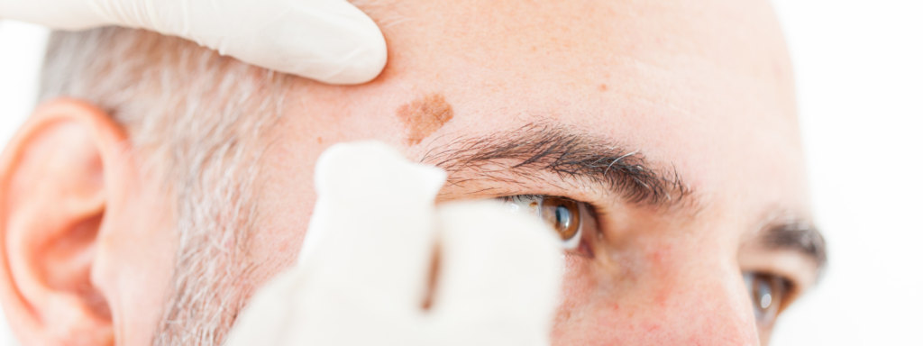 Solar Lentigo (Age Spots) – Causes, Symptoms & Treatment | SJPP Dermatology